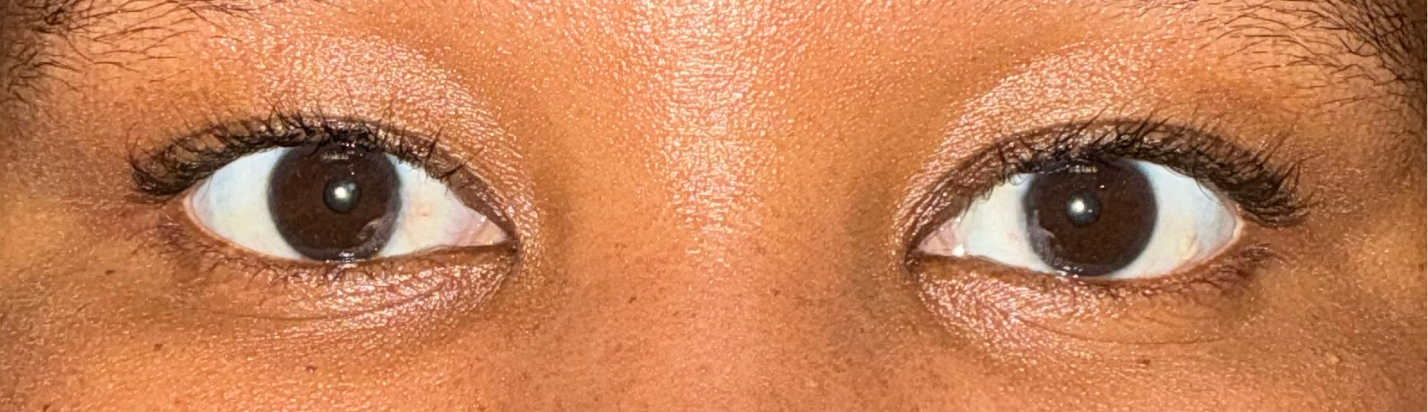 Pterygium Surgery - Dr. Michael Djan